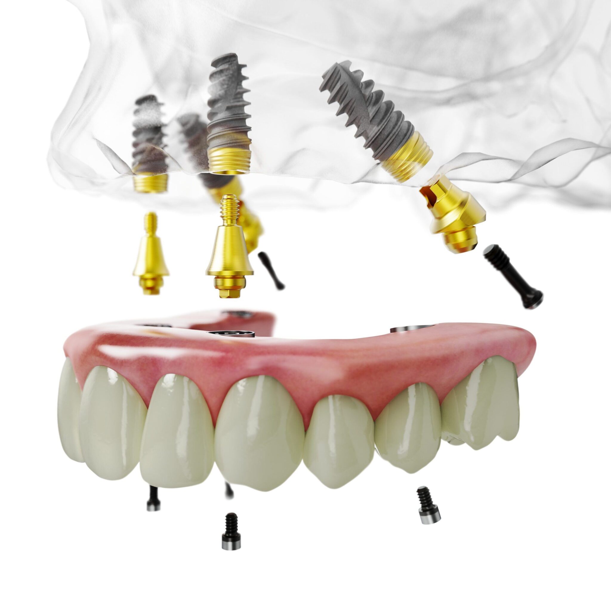 All-On-4 Dental Implants | Cameo Dental Specialists