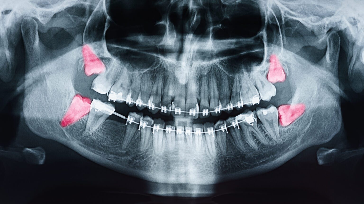 The Recovery Timeline for Wisdom Teeth Removal West Loop Patients Rely ...